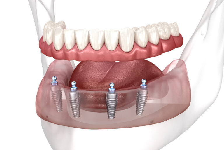 Implant Supported Dentures | Phoenix, AZ Area | Restore Denture ...