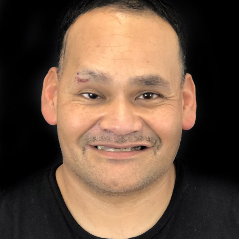 Snap-On Dentures | Phoenix, AZ Area | Denture Implants